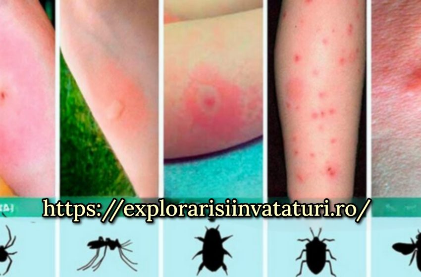 Înțepături de insecte: 12 tipuri și cum să le tratezi pe fiecare dintre ...